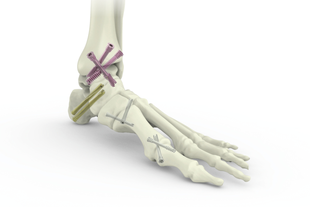 FootMotion Large Screws - DBM Medical Group - Implant Screws