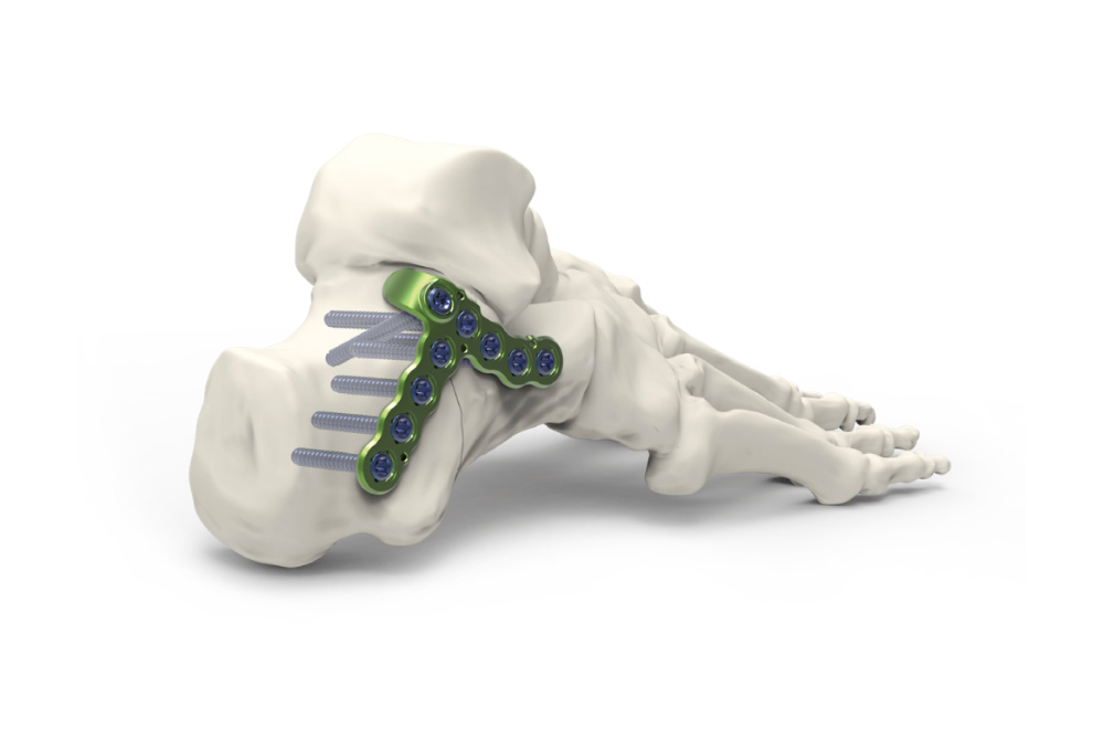 Calcan Heal - DBM Medical Group - Foot Trauma Solution