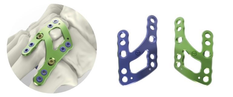 Footmotion Plating System - DBM Medical Group