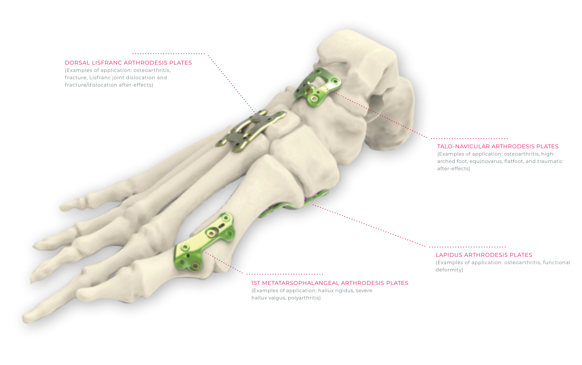Footmotion Plating System - DBM Medical Group
