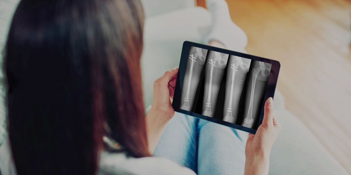 Precice™ - DBM Medical Group